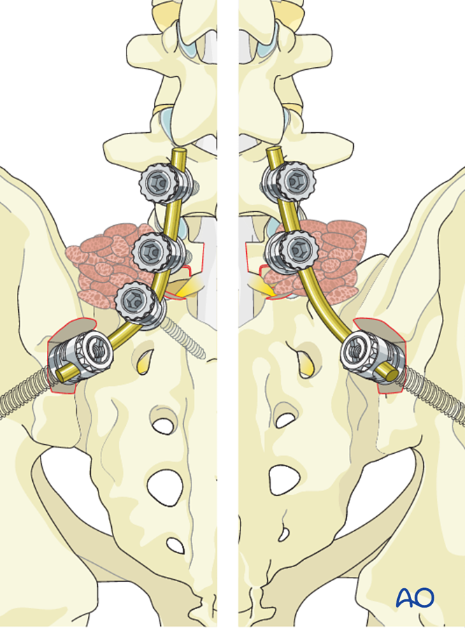 Posterior fusion of L4-S1 (with or without pelvic fixation or ala) for ...