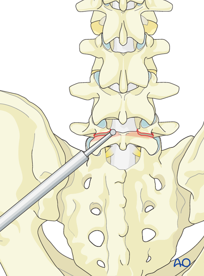 Primary repair with pars screw for Spondylolisthesis - Type 1
