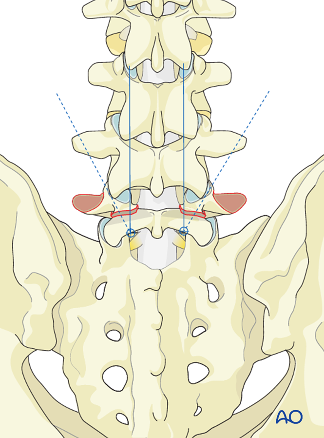 Primary repair with pars screw for Spondylolisthesis - Type 1