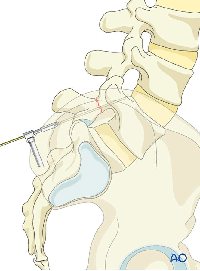 Primary repair with pars screw for Spondylolisthesis - Type 1
