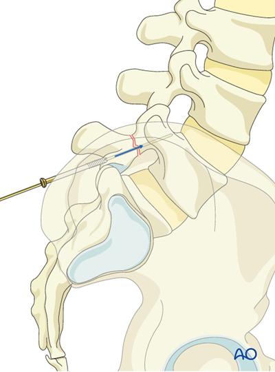 Primary repair with pars screw for Spondylolisthesis - Type 1