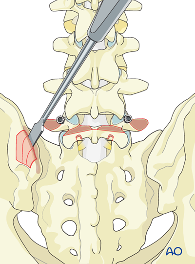 Primary repair with pedicle screw and rod for Spondylolisthesis - Type 1