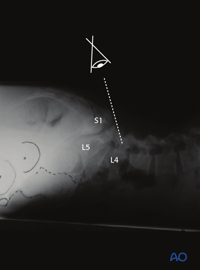 S1 Pedicle and delta screw insertion