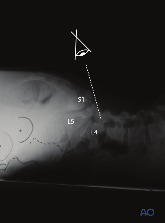 S1 Pedicle and delta screw insertion