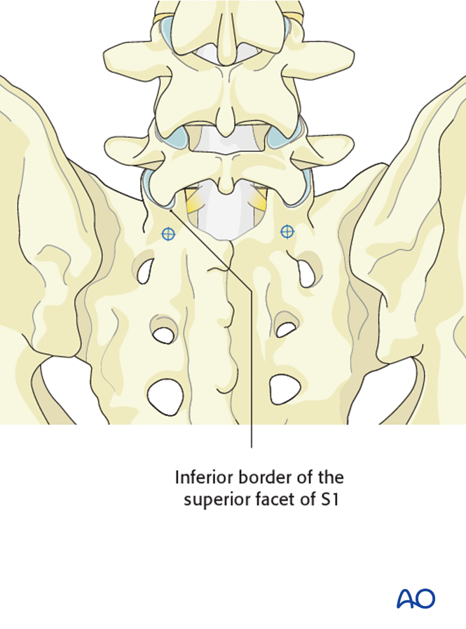 S1 Pedicle and delta screw insertion