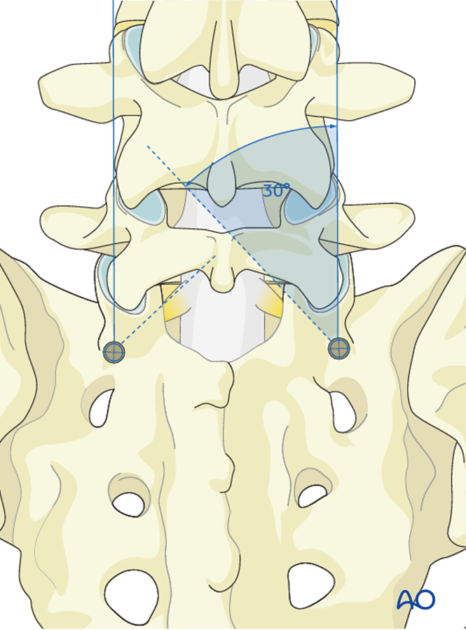S1 Pedicle and delta screw insertion