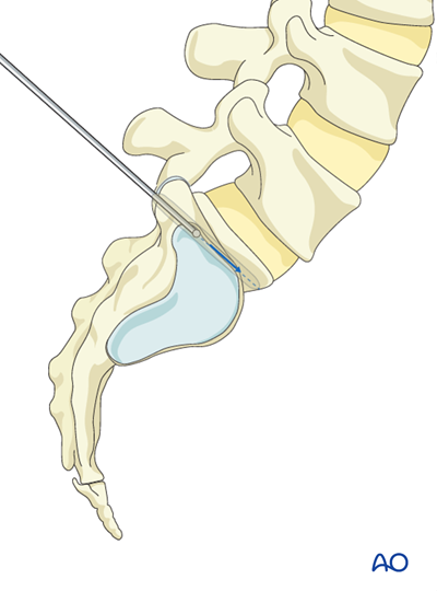 S1 Pedicle and delta screw insertion