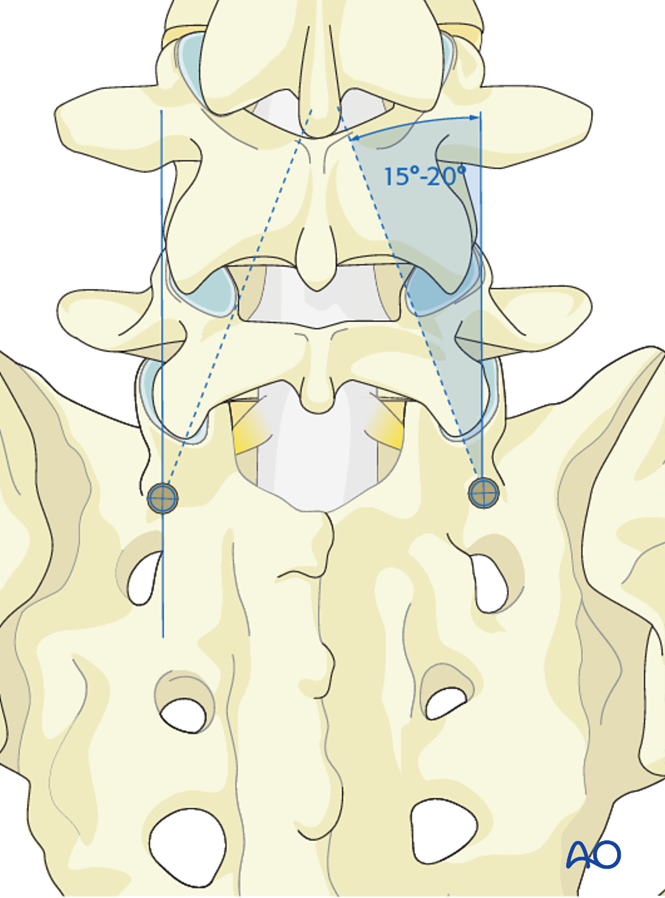 S1 Pedicle and delta screw insertion