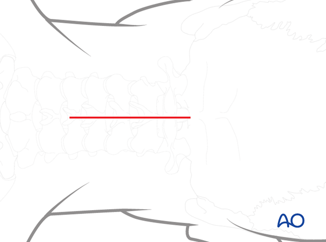 Occipitocervical fusion for Occipitocervical, unstable, low ESCC