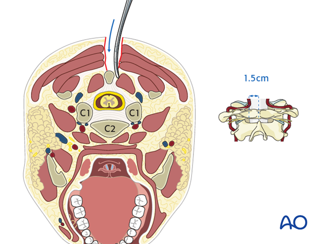 Posterior access to the occipitocervical spine