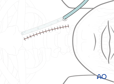 Anterior access to the cervical spine (C3–C7)