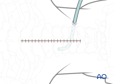 Posterior access to the cervicothoracic junction