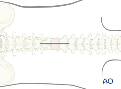 Posterior decompression and stabilization with corpectomy for ...