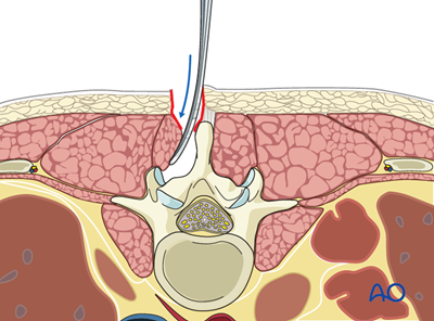 Posterior midline access to the thoracolumbar spine