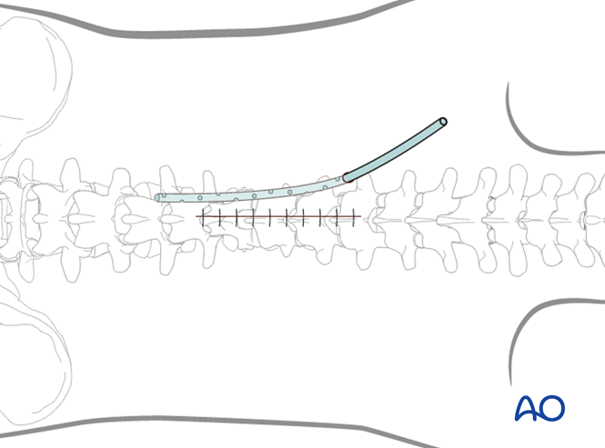 Posterior midline access to the thoracolumbar spine