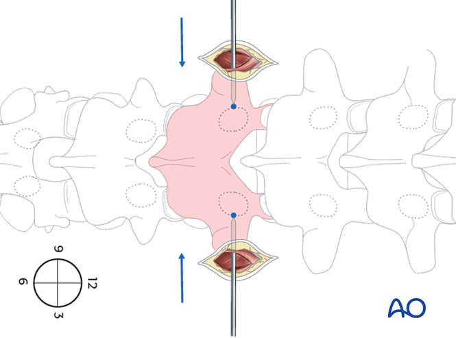 Percutaneous pedicle screw insertion in the thoracolumbar spine