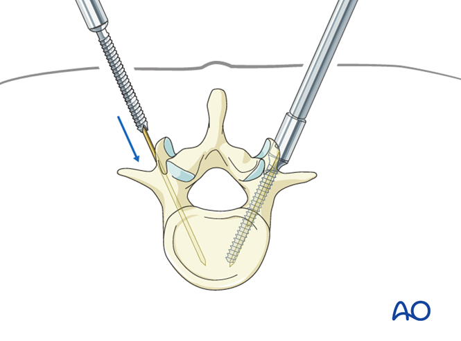 Percutaneous pedicle screw insertion in the thoracolumbar spine