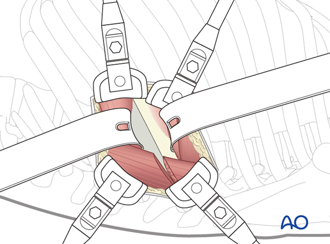 Left sided thoracotomy (T3-L1/2)