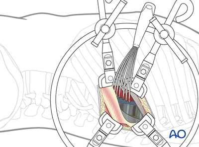Left sided thoracotomy (T3-L1/2)
