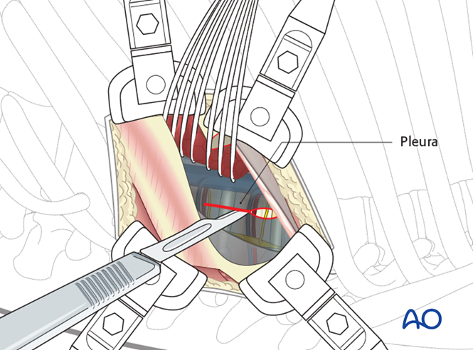 Left sided thoracotomy (T3-L1/2)