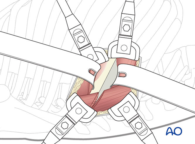 Right sided thoracotomy (T3-T10)
