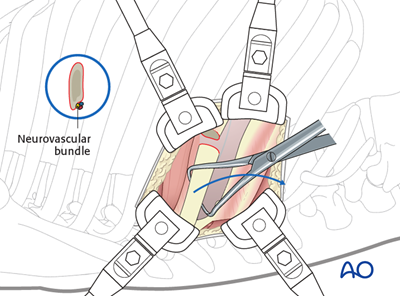Right sided thoracotomy (T3-T10)