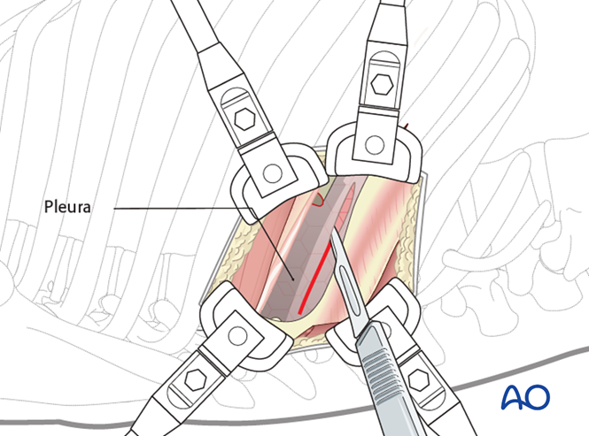 Right sided thoracotomy (T3-T10)