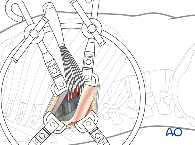 Right sided thoracotomy (T3-T10)