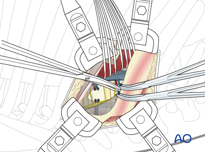 Right sided thoracotomy (T3-T10)