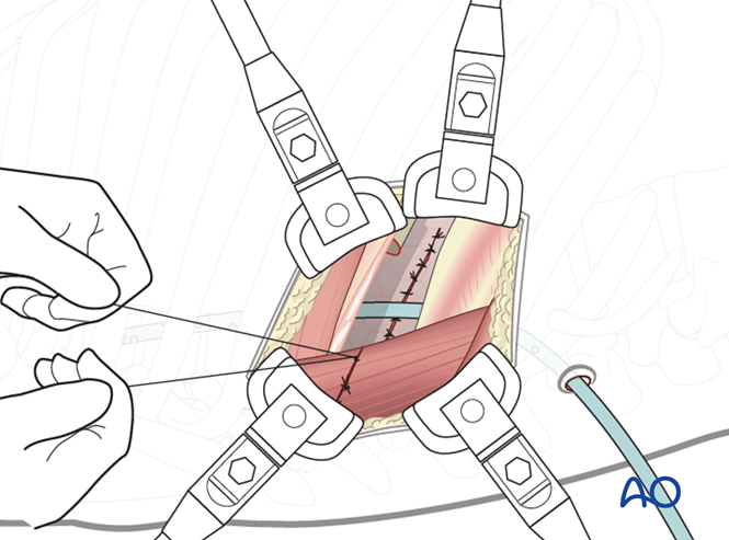 Right sided thoracotomy (T3-T10)