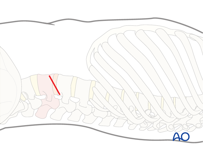 Minimally invasive lumbotomy in L2-L4