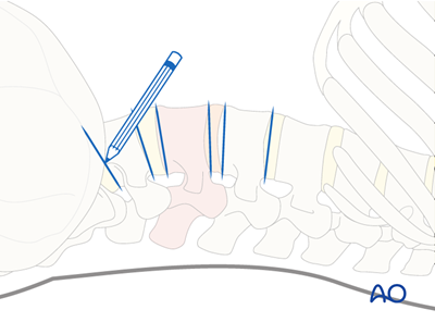 Minimally invasive lumbotomy in L2-L4