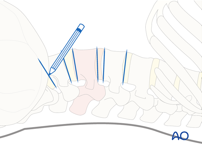 Minimally invasive lumbotomy in L2-L4