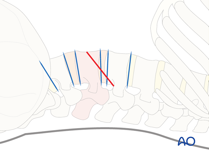 Minimally invasive lumbotomy in L2-L4