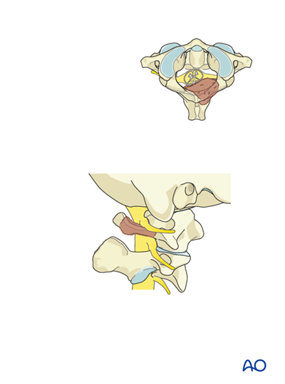 Occipitocervical fusion for Occipitocervical, stable, high ESCC