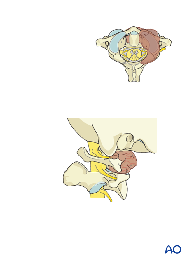 Occipitocervical fusion for Occipitocervical, unstable, low ESCC