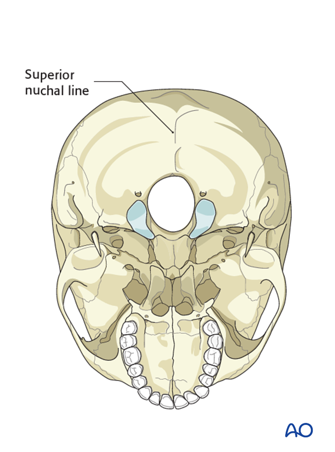 Occipitocervical fusion for Occipitocervical, unstable, low ESCC
