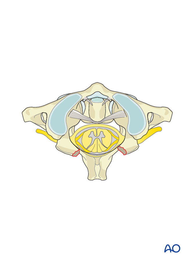 Occipitocervical fusion for Occipitocervical, stable, high ESCC