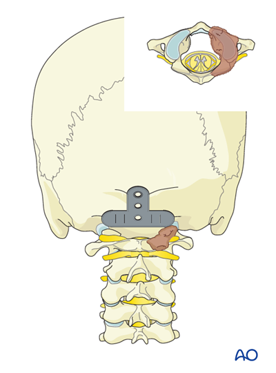 Occipitocervical fusion for Occipitocervical, unstable, low ESCC