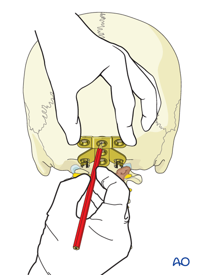 Occipitocervical fusion for Occipitocervical, unstable, low ESCC