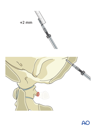Occipitocervical fusion for Occipitocervical, stable, high ESCC