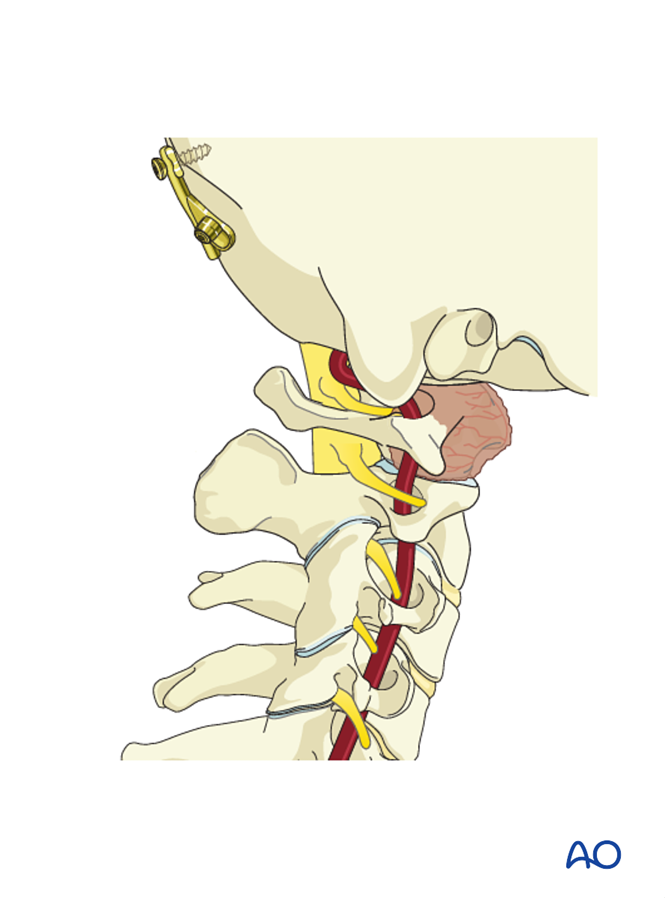 Occipitocervical fusion for Occipitocervical, unstable, low ESCC