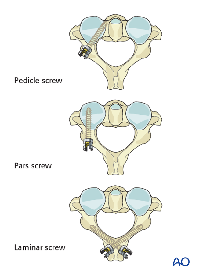 Instrumentation for occipitocervical fixation