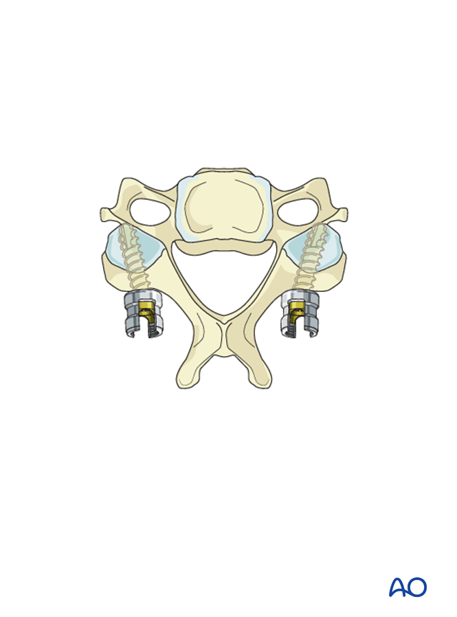 Instrumentation for occipitocervical fixation
