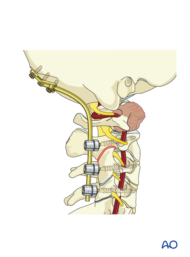 Occipitocervical fusion for Occipitocervical, unstable, low ESCC