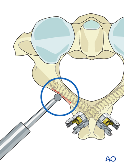 Instrumentation for occipitocervical fixation