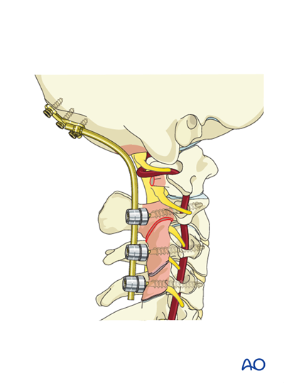 Occipitocervical fusion for Occipitocervical, stable, high ESCC