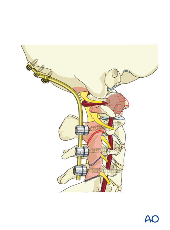 Occipitocervical fusion for Occipitocervical, unstable, high ESCC