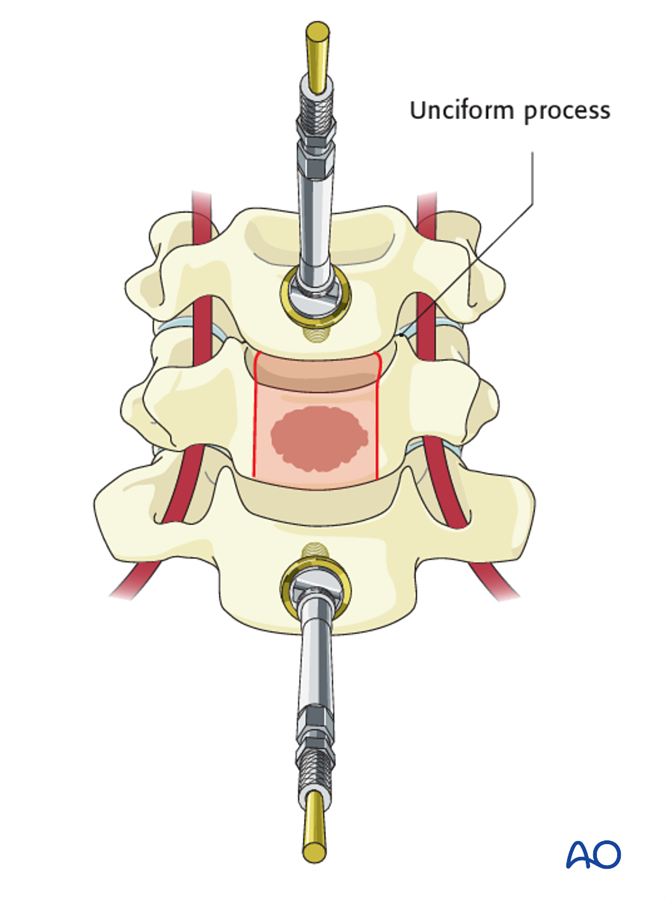 Anterior decompression and stabilization for Subaxial cervical, stable ...