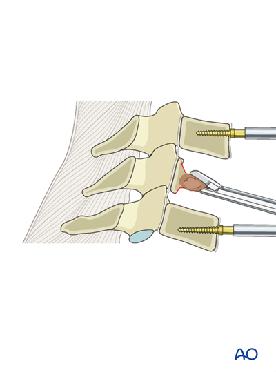 Anterior corpectomy and stabilzation for Subaxial cervical, unstable ...
